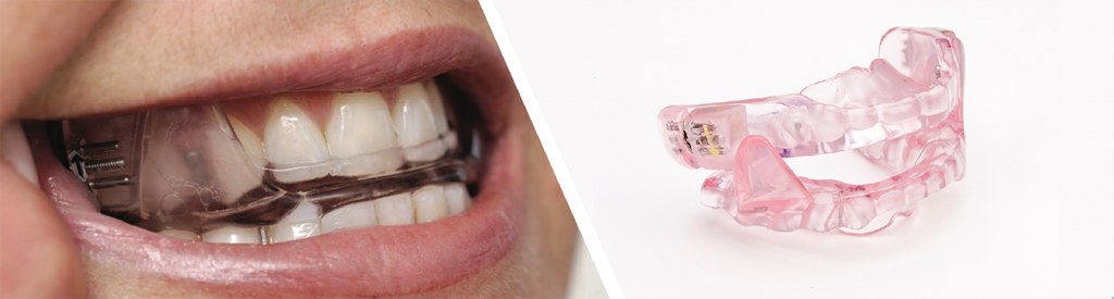 Evaluating Longterm Mandibular Advancement Splint Responders - Thoracic ...